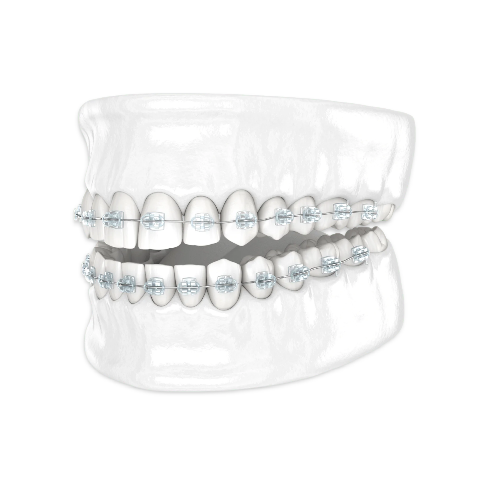 Frenillos cerámicos - Clínica Dental Santa blanca