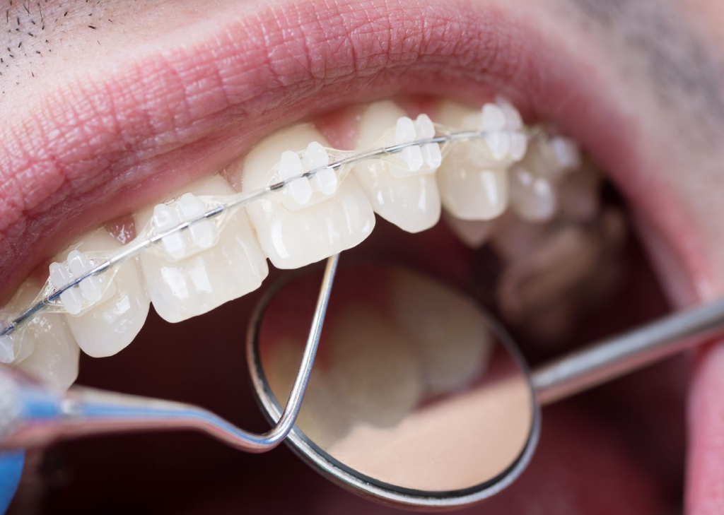 Frenillos cerámicos - Clínica Dental Santa blanca