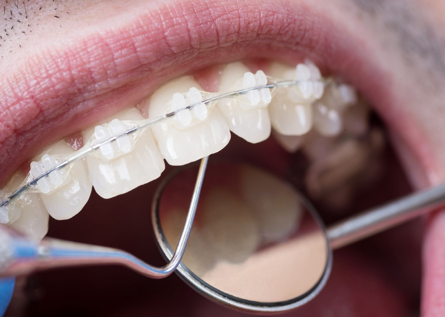 Frenillos cerámicos - Clínica Dental Santa blanca