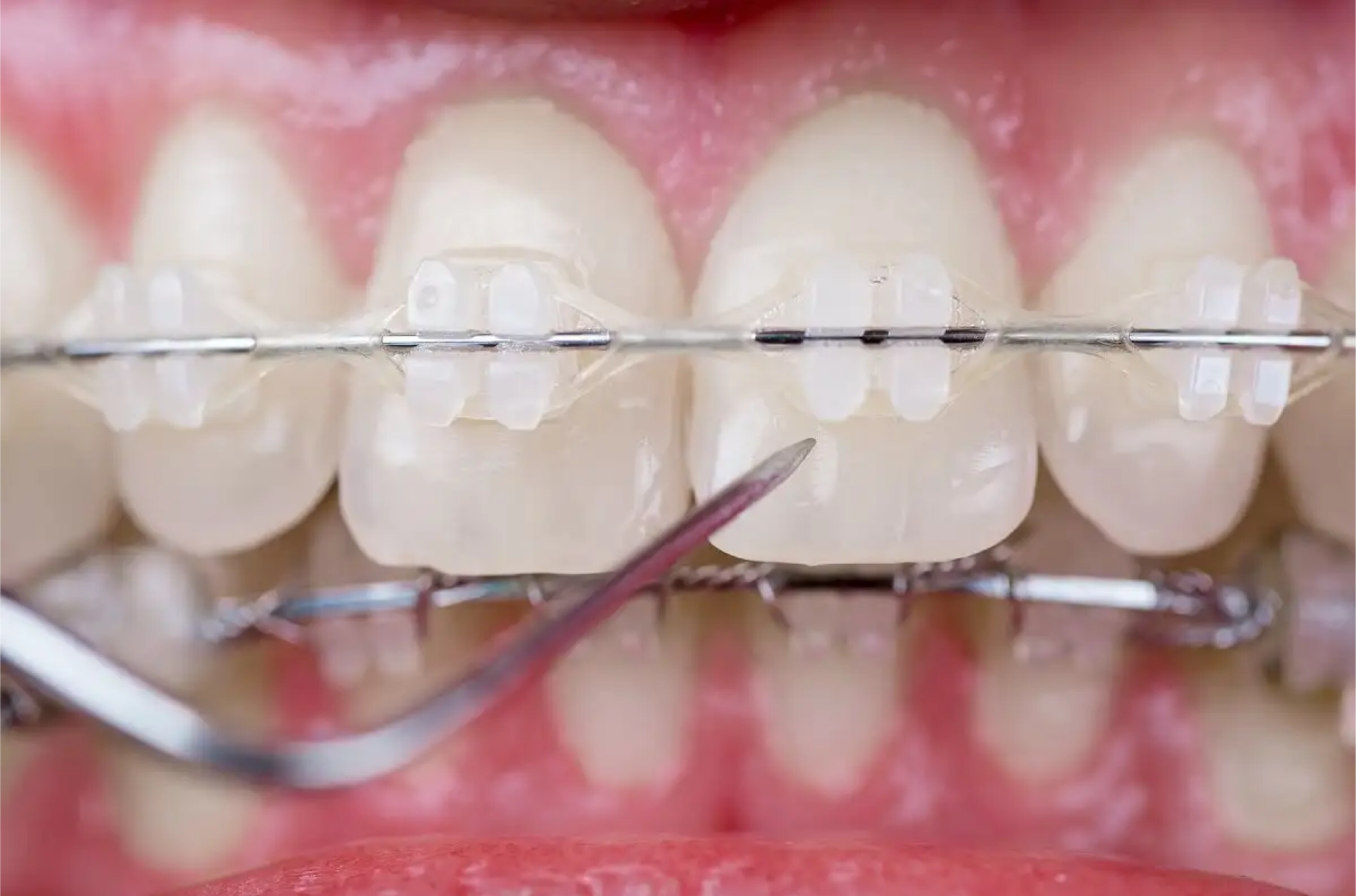 Frenillos cerámicos - Clínica Dental Santa blanca