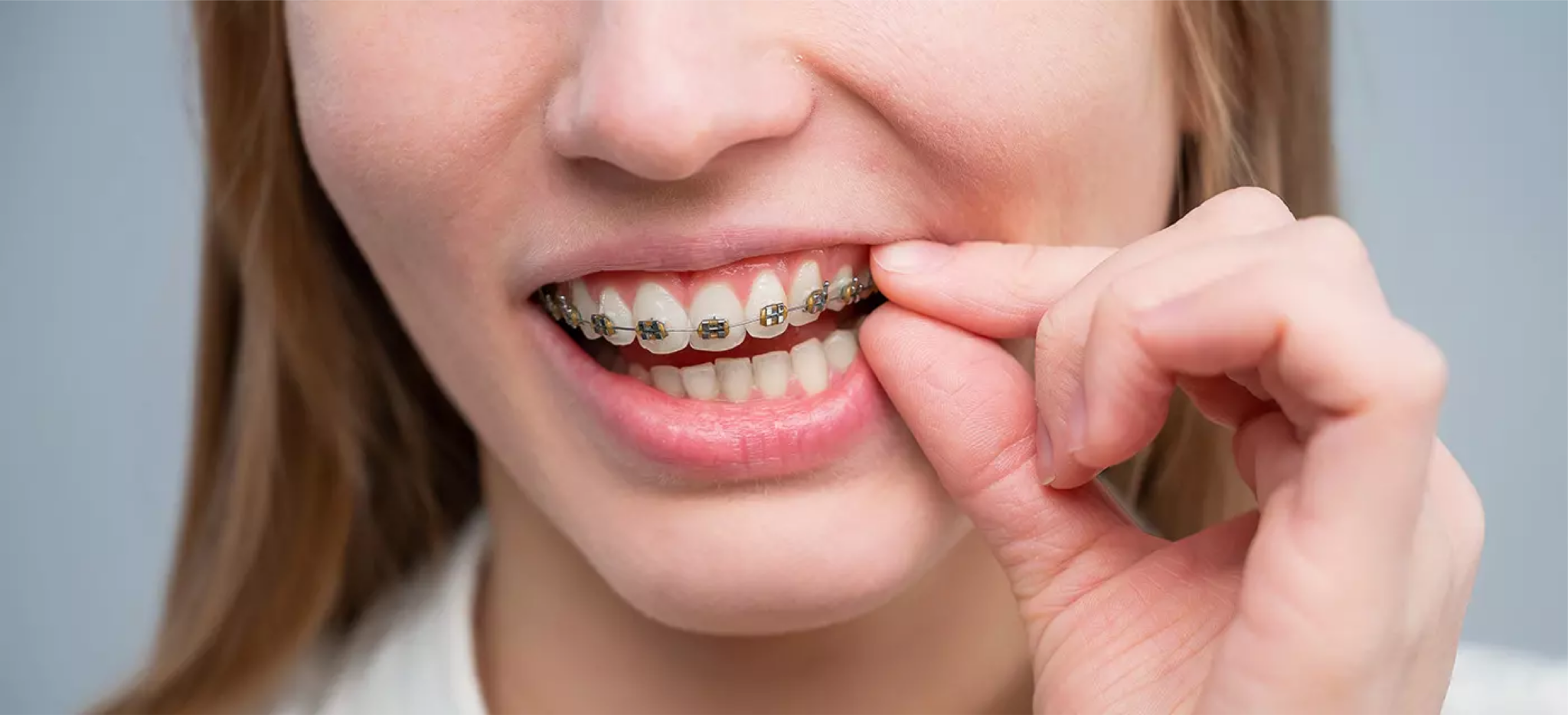 Frenillos metálicos - Clínica Dental Santa blanca